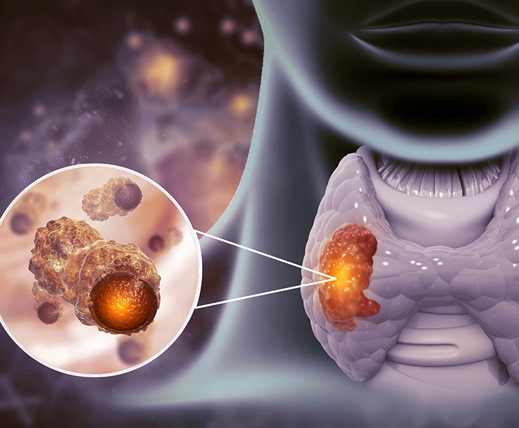 Le cancer de la thyroïde - Chirurgie Thyroïde Paris