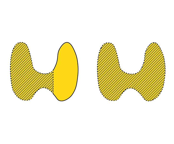 Etendue de la thyroïdectomie - Chirurgie Thyroïde Paris