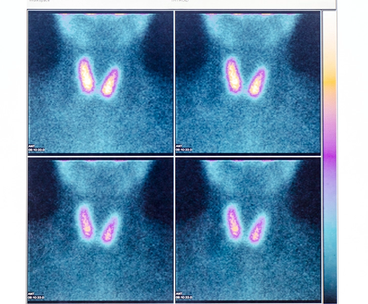 Scintigraphie de la thyroïde - Chirurgie Thyroïde Paris