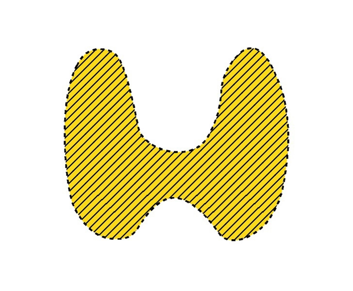 La thyroïdectomie totale - Chirurgie Thyroïde Paris