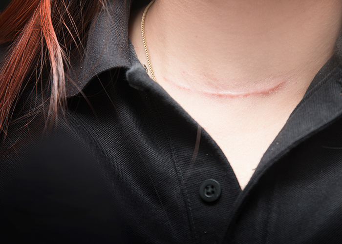 L'aspect de la cicatrice - Chirurgie Thyroïde Paris