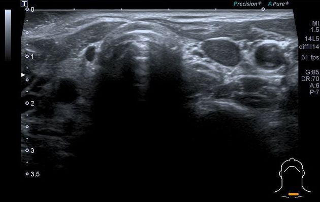 L'échographie des parathyroïdes - Chirurgie Thyroïde Paris
